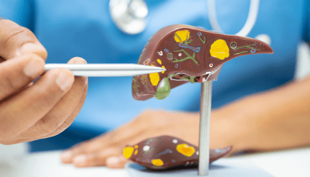 What are the Different Types of Gallstones?