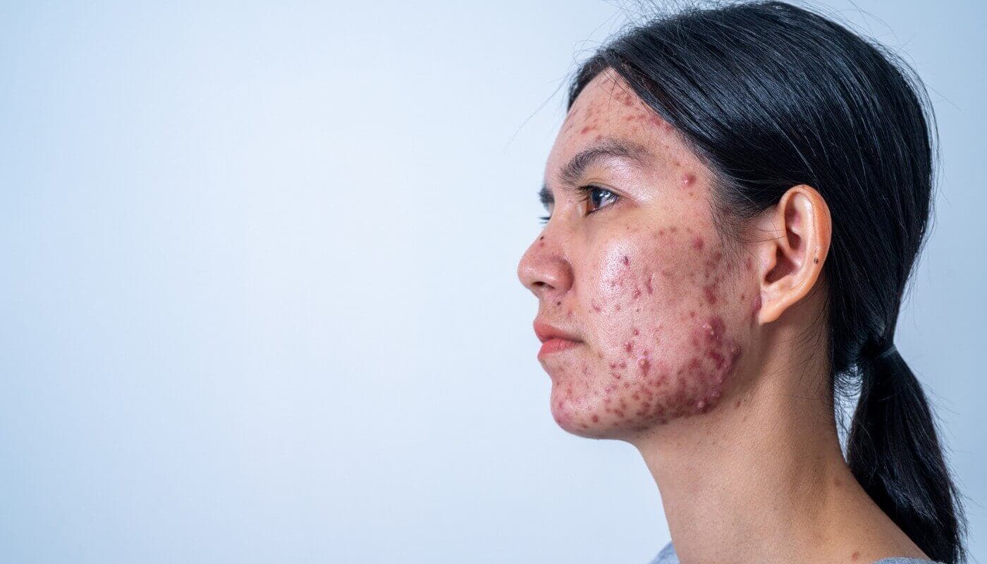 Oily Lumps on Face? Sebaceous Hyperplasia Explained