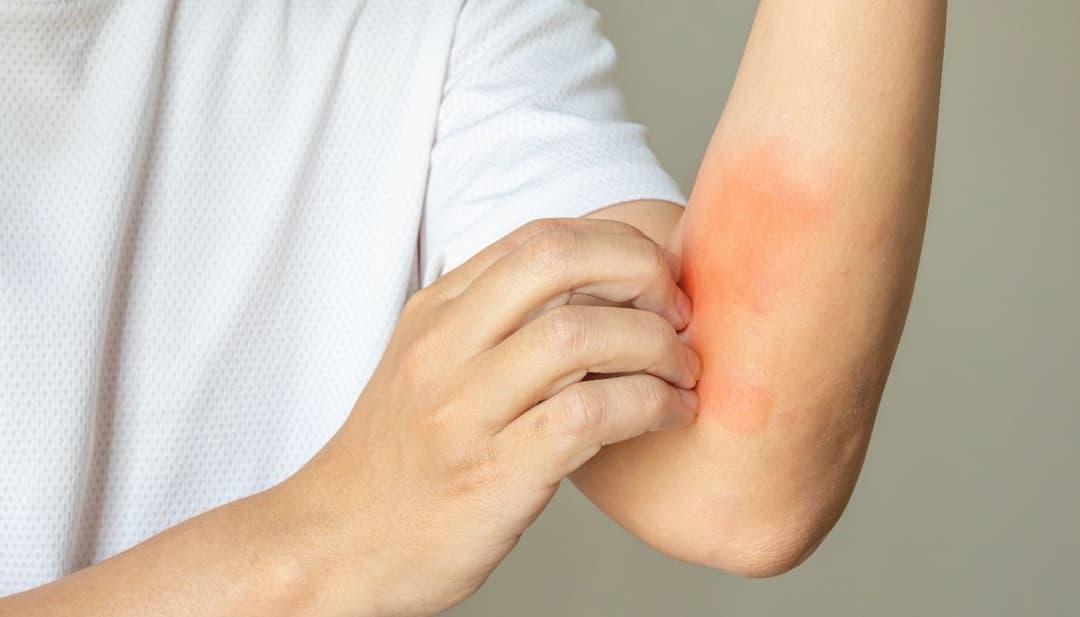 How to cure Menopause Related Itchy Skin Naturally