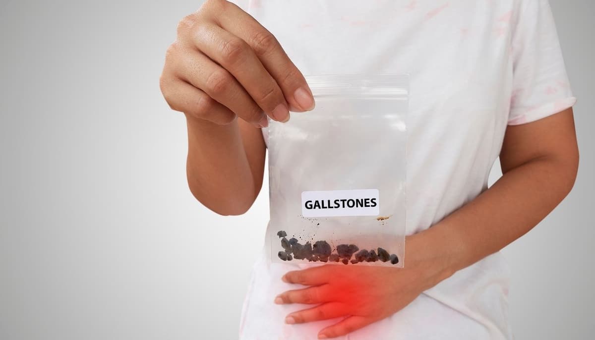 Home Remedies for Gall Bladder Stones