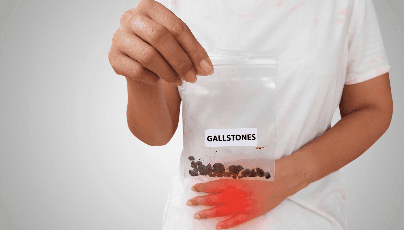 What are the Different Types of Gallstones?